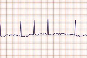 Cardiac Arrhythmia Interpretation Courses – Cardiovascular Nursing ...