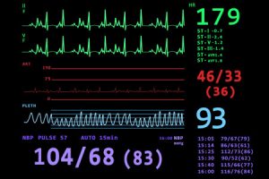 Cardiac Arrhythmia Interpretation Courses – Cardiovascular Nursing ...