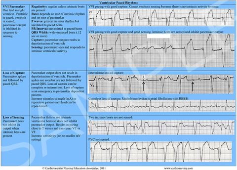 Cardiac Arrhythmia Reference Chart (PDF) – Cardiovascular Nursing ...